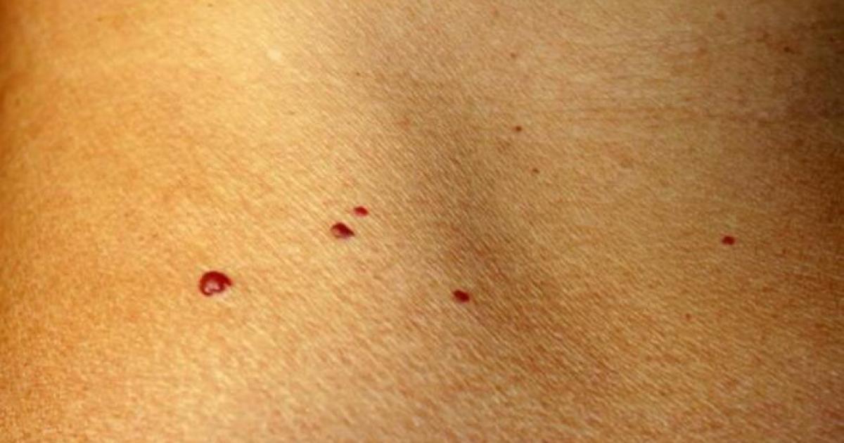 Piros foltok vannak a bőrödön? Elmondjuk, mit jelentenek!